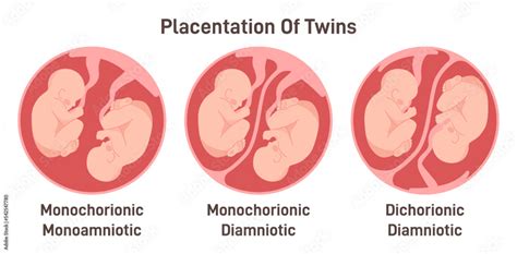 Twin Types Monozygotic Or Dizygotic Placentation Of Twins Monochorionic Stock Vector Adobe Stock