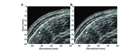 In Vivo 3d Us Data Of A Tibialis Anterior Acquired With A Radial Sweep