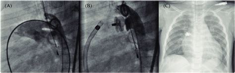 Early Embolization Of A 10 Mm Avp Ii After Pda Closure Multiple