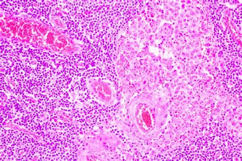 Rcpathds Breast Rcpath Royal College Of Pathologists Rcpath