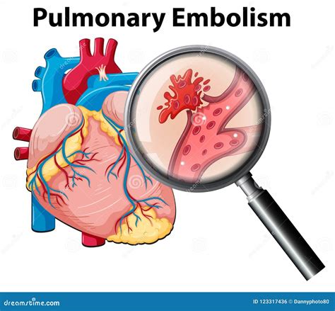Pulmonary Embolism Human Silhouette With Highlighted Circulatory