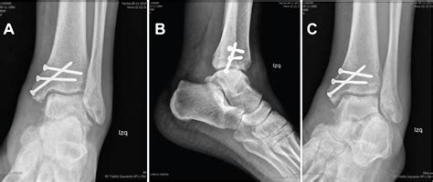 Medial Malleolus Fracture
