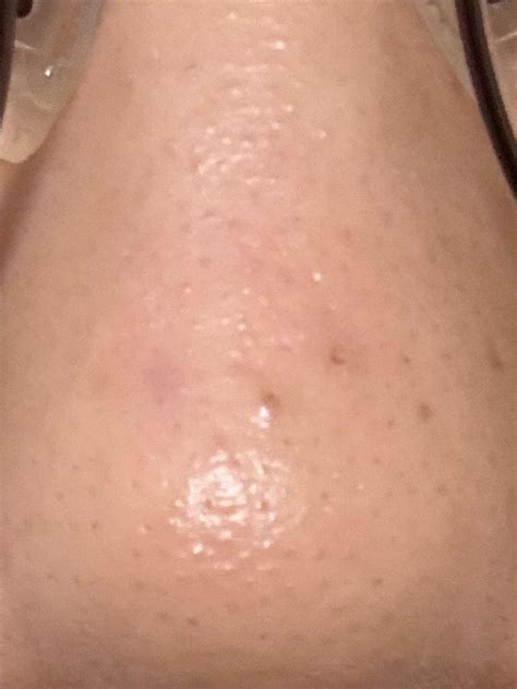 코 여드름 블랙헤드 지식in