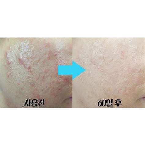흉터연고 제거력 100 네이버 블로그