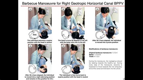 Barbecue Manoeuvre For Right Geotropic Horizontal Canal Bppv Youtube
