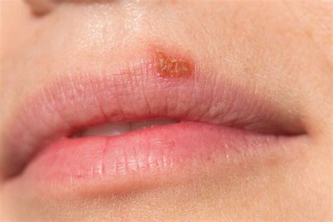 Oral Herpes Can You Get Herpes In Your Throat