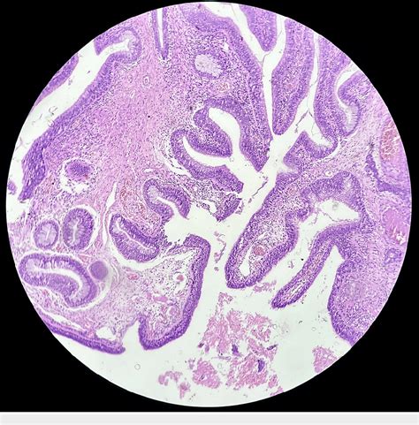 Figure 1 From Respiratory Epithelial Adenomatoid Hamartoma In A Young