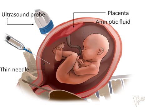 How Long Is An Amniocentesis Needle At Gordon Glazer Blog