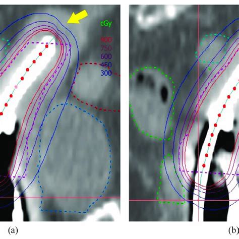 3d Hdr Icbt Dose Volume Histogram Comparing 192ir And 60co Download Scientific Diagram 3d Hdr Icbt Dose Volume Histogram Comparing 192ir And 60co Download Scientific Diagram