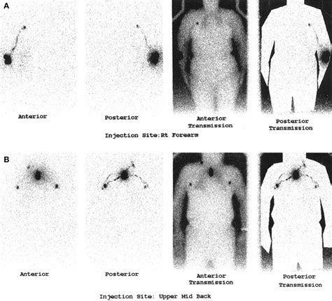 Whole Body Lymphoscintigraphy Using Transmission Scans Journal Of