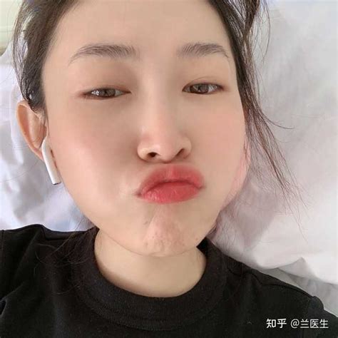 为什么嘴唇干裂时用舌头舔唇润湿，嘴唇会更痛？是口水中有什么成分导致的么？ 知乎