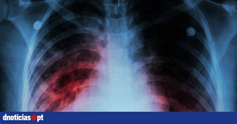 Casos De Tuberculose Diminuíram Em 2021 Mas Diagnóstico Ainda é Tardio