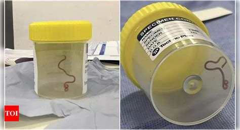 Brain Worm Live Worm Found In Australian Womans Brain In World First