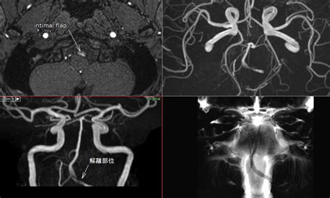 椎骨動脈解離（vertebral Artery Dissection）