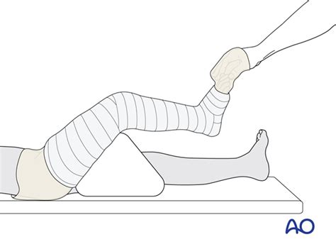 Preliminary Treatment Splinting For Epiphysiolysis Salter Harris I