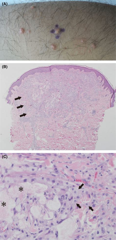 Histological Findings Of A Skin Biopsy Specimen From The Left Forearm