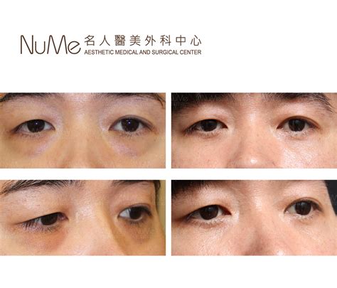 EyeBag - NuMe