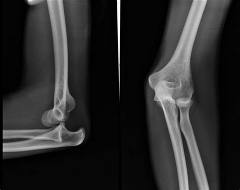 Elbow Dislocation Buyxraysonline