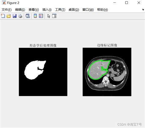 【第 26 章 基于最小误差法和区域生长的医学影响分割系统 matlab深度学习实战gui项目】 基于matlab gui的医用系统开发