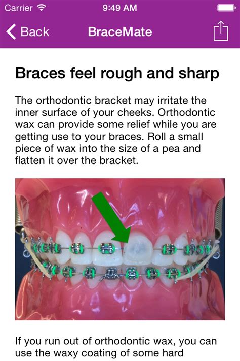 Braces Diy Kit At Esperanza Bruns Blog