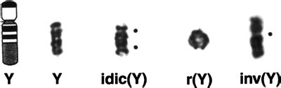 Sex Chromosomes Sex Chromosome Disorders And Disorders Of Sex Development Basicmedical Key
