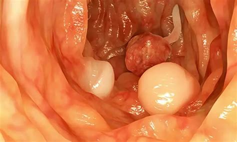 Tại Sao Lại Bị Polyp Trong Ruột Có 7 Lý Do Tại Sao