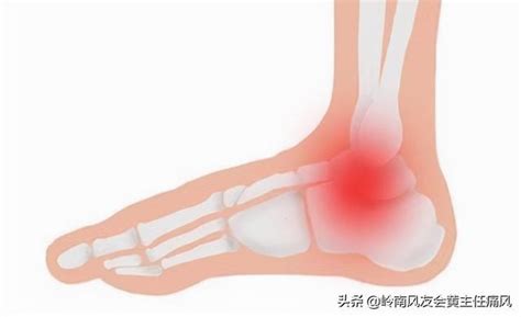做好這3件事，或痛風反覆發作怎麼辦？醫生：能有效緩解 每日頭條