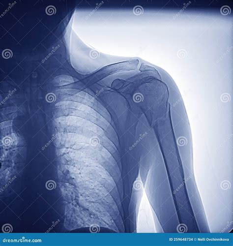 Osteoarthritis X Ray Shoulder