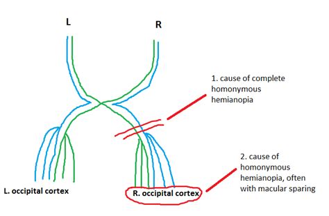 Homonymous Hemianopia Bitemporal Hemianopia Barts Wiki Fandom