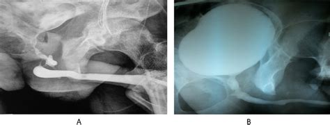 Urethrogram Of Case With Failed Viu A Before Urethroplasty B