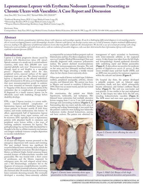 Lepromatous Leprosy With Erythema Nodosum Leprosum Presenting As Docslib