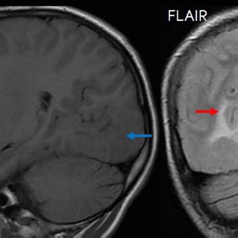 T2wi And T2 Gradient Echo Show Cavernoma Of The Left Temporal Lobe