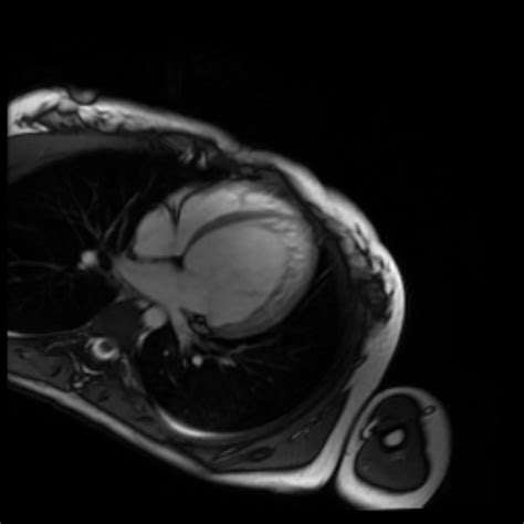Non Compaction Kardiomyopathie Pacs