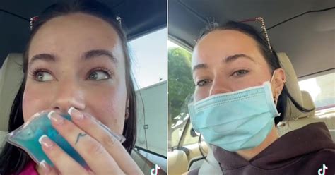 Una Mujer Terminó Desfigurada Tras Rellenarse Los Labios Con ácido