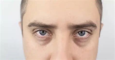 Bags Under Eyes Treatment The Ultimate Guide