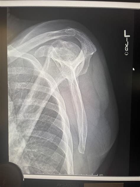 Scapular Y What Do You Think R Radiology
