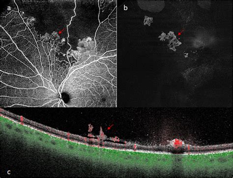 Phenotyping Of Retinal Neovascularization In Ischemic Retinal Vein Occlusion Using Wide Field