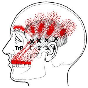 Temporalis Trigger Points And Referred Pain Patterns Trigger Point