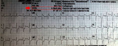 Candlelightmedic QT Interval