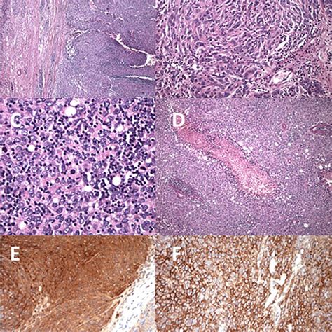 A Follicular Dendritic Cell Sarcoma Shows Well Circumscribed Borders Download Scientific