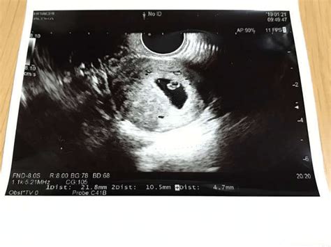 妊娠6週目（6w0d～6d）のエコー写真とエピソード｜妊娠2ヶ月｜cozre コズレ 子育てマガジン