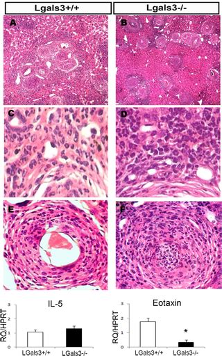 Galectin 3 Histone Deacetylases And Hedgehog Signaling Possible