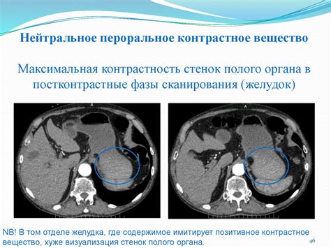 Контрастное усиление при совмещенной позитронной эмиссионной и ...