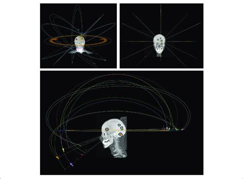 Arc Arrangement For Single Isocenter Volumetric Modulated Arc Therapy