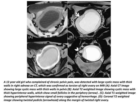 Presentation11 Radiological Imaging Of Ovarian Torsion Ppt