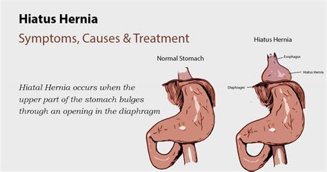 Hiatus Hernia Treatment In India Laparoscopic Hernia Surgery