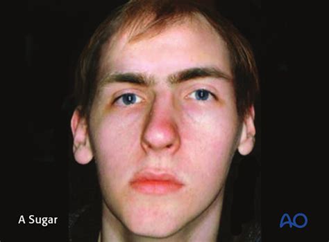 Hemifacial Microsomia Classification
