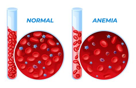 Golden Blood The Rare And Mysterious Rh Null Blood Type