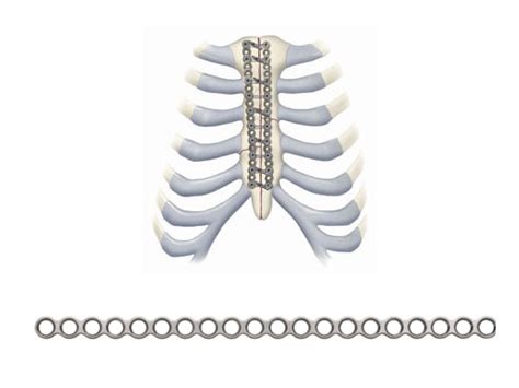 Modular Sternal Cable System