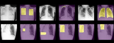 TorchXRayVision A Library Of Chest X Ray Datasets And Models